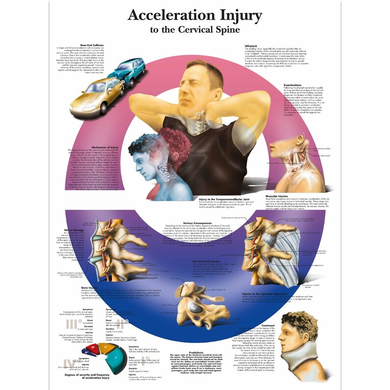 Acceleration Injury Chart Anatomy Human Physiology Charts Medical ...