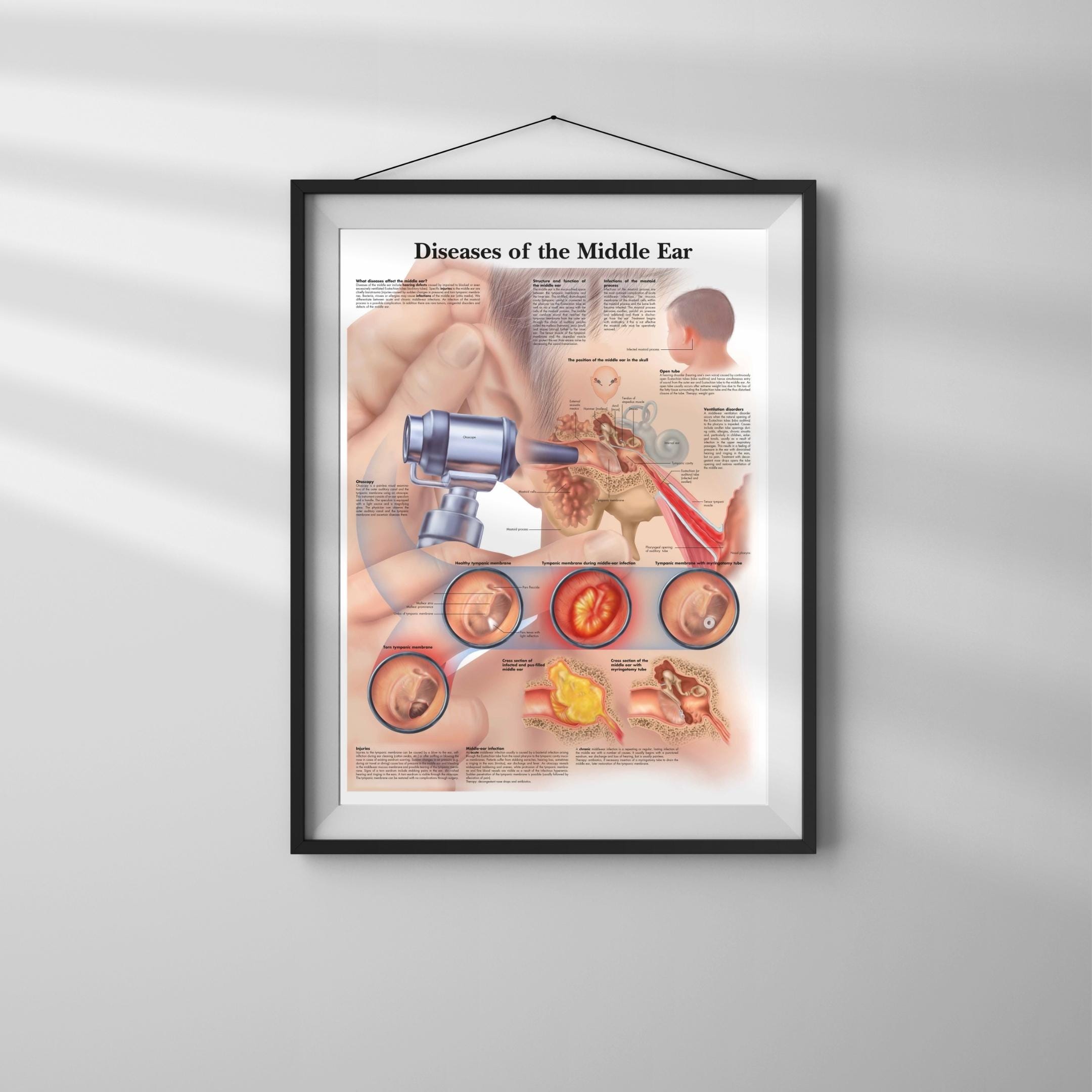 Diseases of Middle Ear Chart Anatomy Human Physiology Charts Medical ...