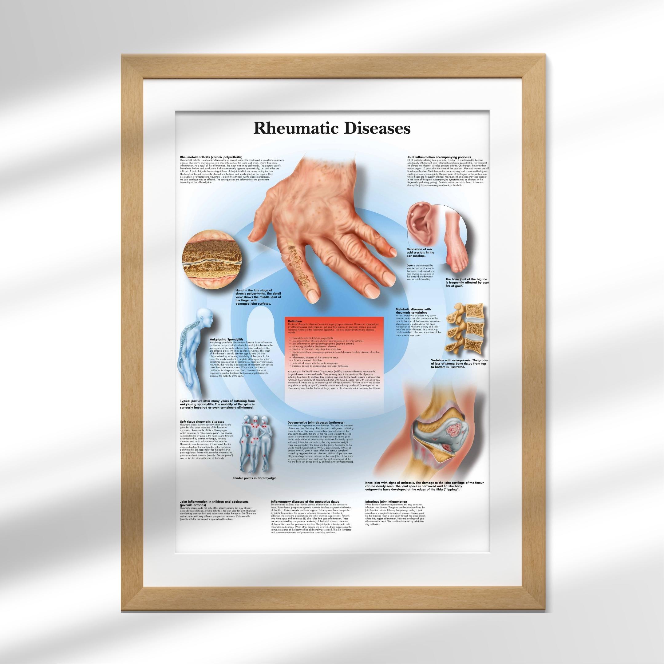 Rheumatic Diseases Chart Anatomy Human Physiology Charts Medical ...