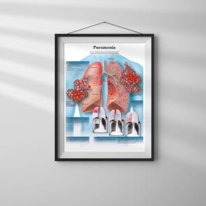Pneumonia Chart Anatomy Human Physiology Charts Medical Student Wall ...