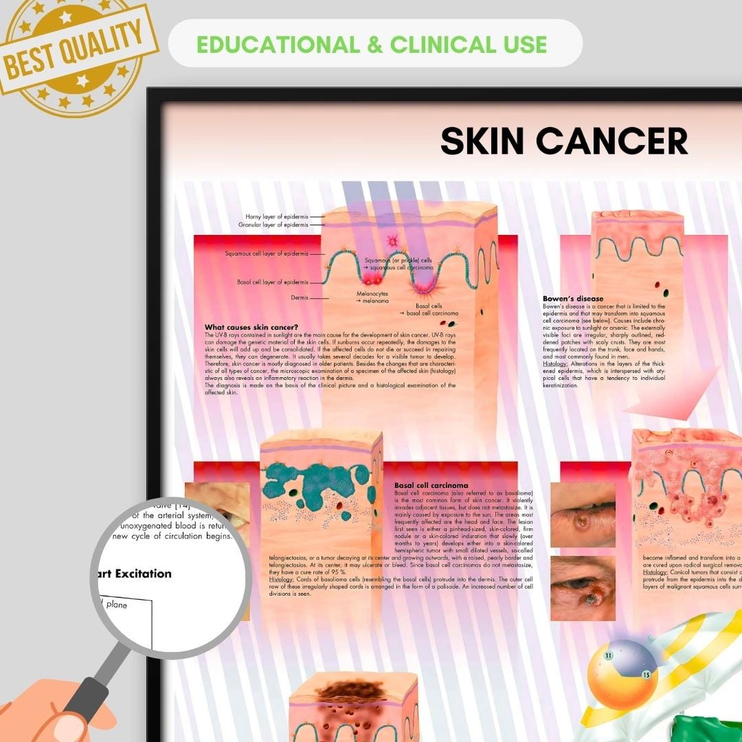 Skin Cancer Poster Anatomy Human Biology Poster Medical Student Poster ...