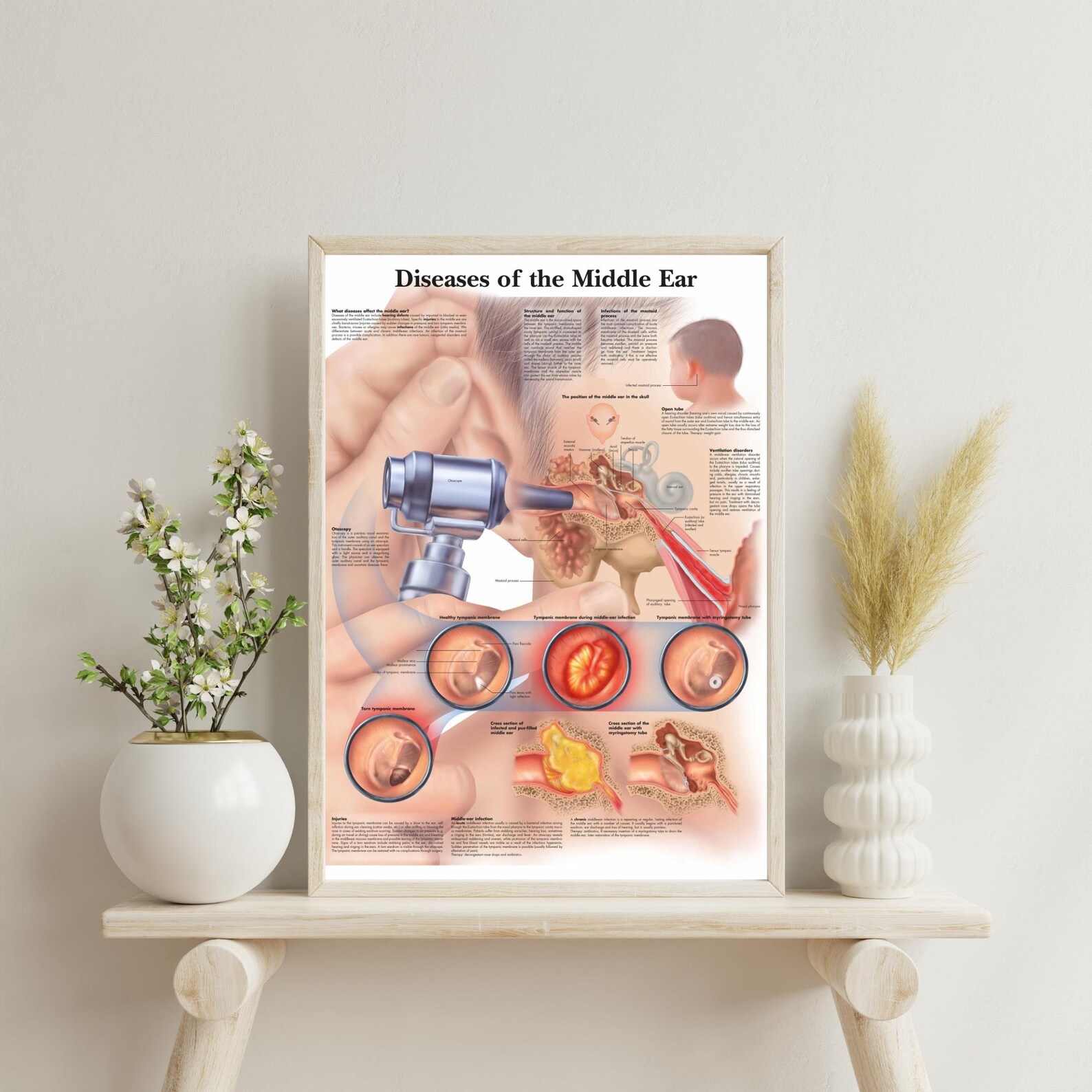 Diseases of Middle Ear Chart Anatomy Human Physiology Charts Medical ...