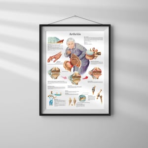 Arthritis Chart Anatomy Human Physiology Charts Medical Student Wall ...