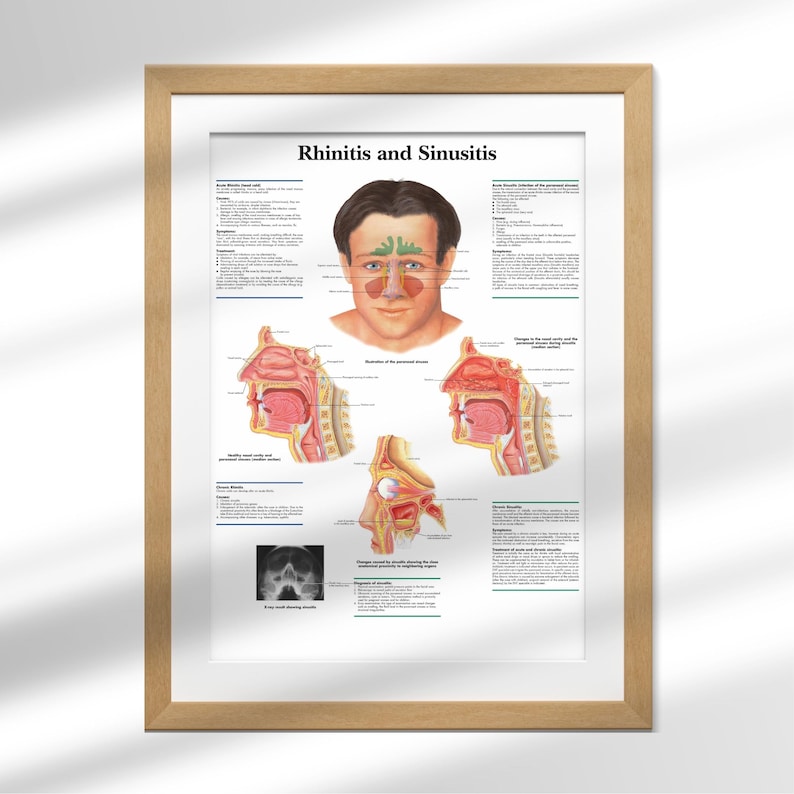 Rhinitis and Sinusitis Chart Anatomy Human Physiology Charts Medical ...