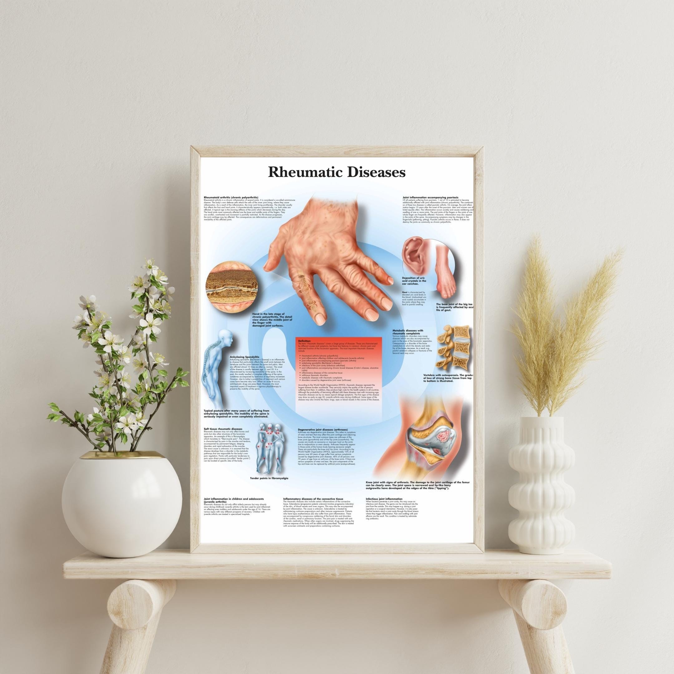 Rheumatic Diseases Chart Anatomy Human Physiology Charts Medical ...