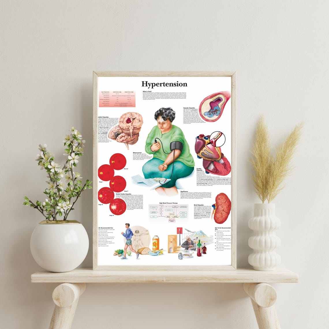 Hypertension Chart Anatomy Human Physiology Charts Medical Student Wall ...