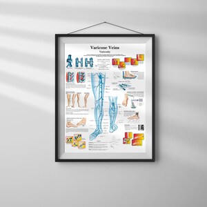 Varicose Veins Chart Anatomy Human Physiology Charts Medical Student Wall Poster Diagram ...