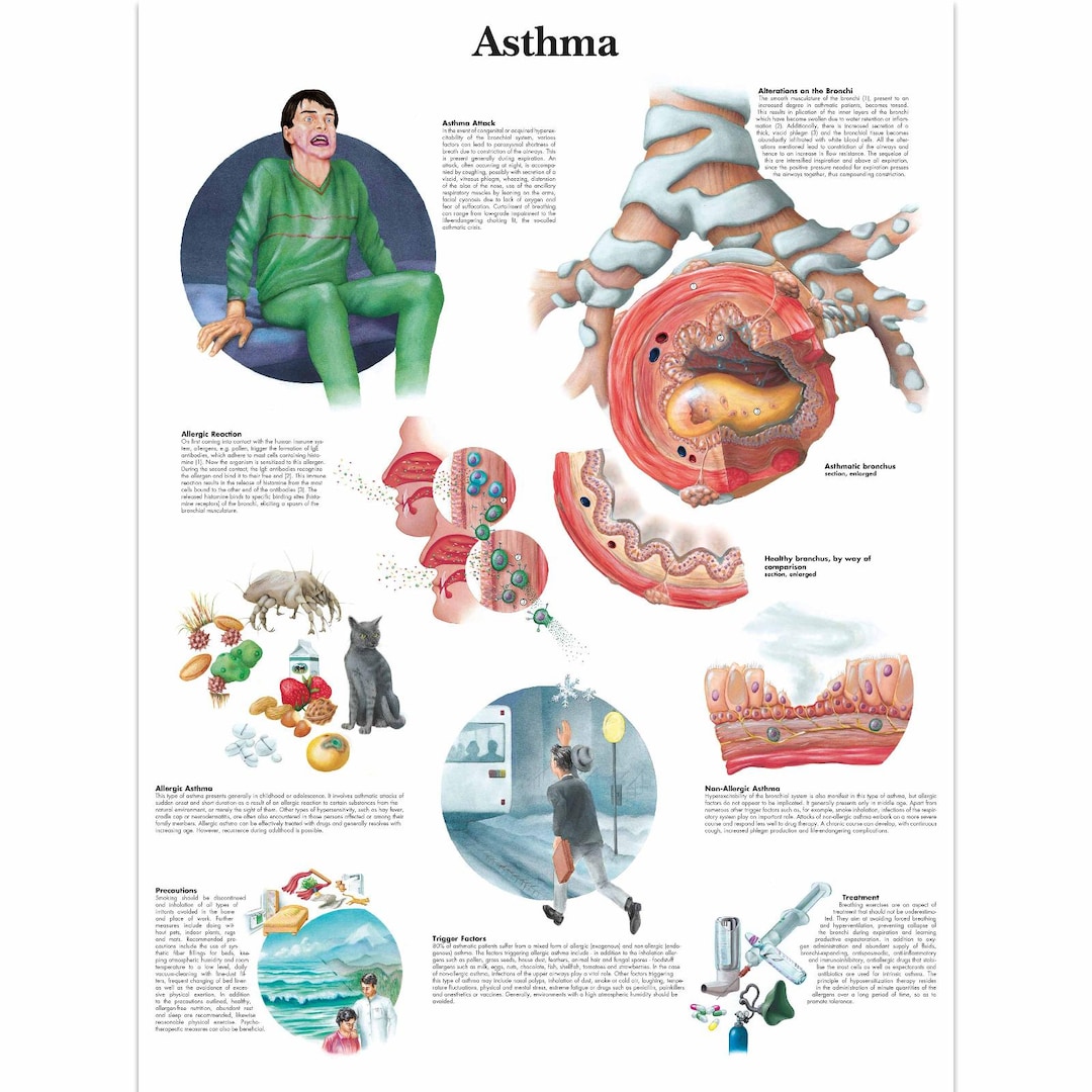 Asthma Chart Anatomy Human Physiology Charts Medical Student Wall ...