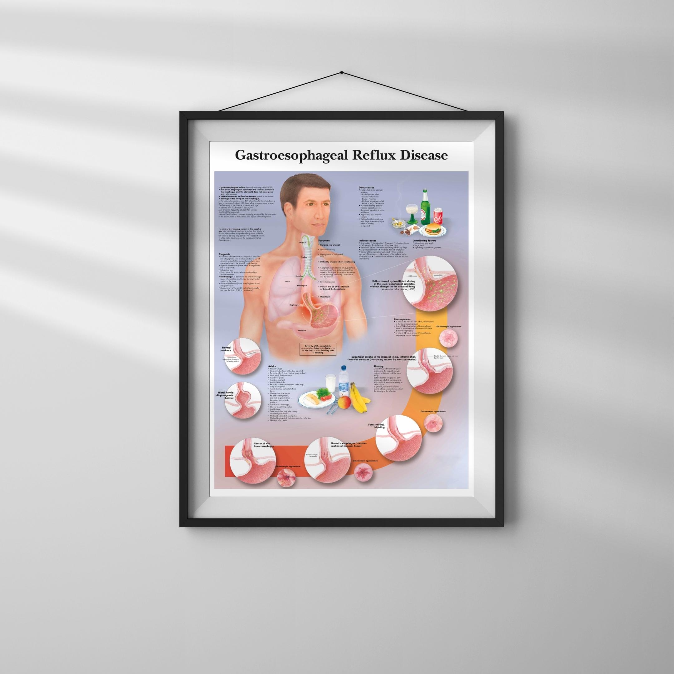 Gastroesophageal Reflux Disease Chart Anatomy Human Physiology Chart ...