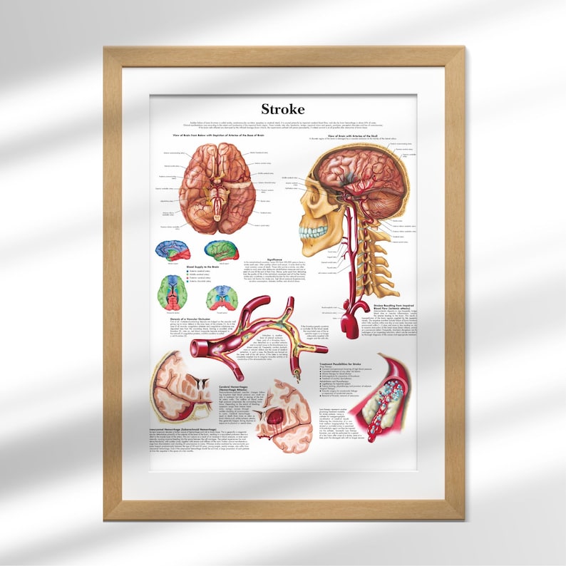 Stroke Chart Anatomy Human Physiology Charts Medical Student Wall ...