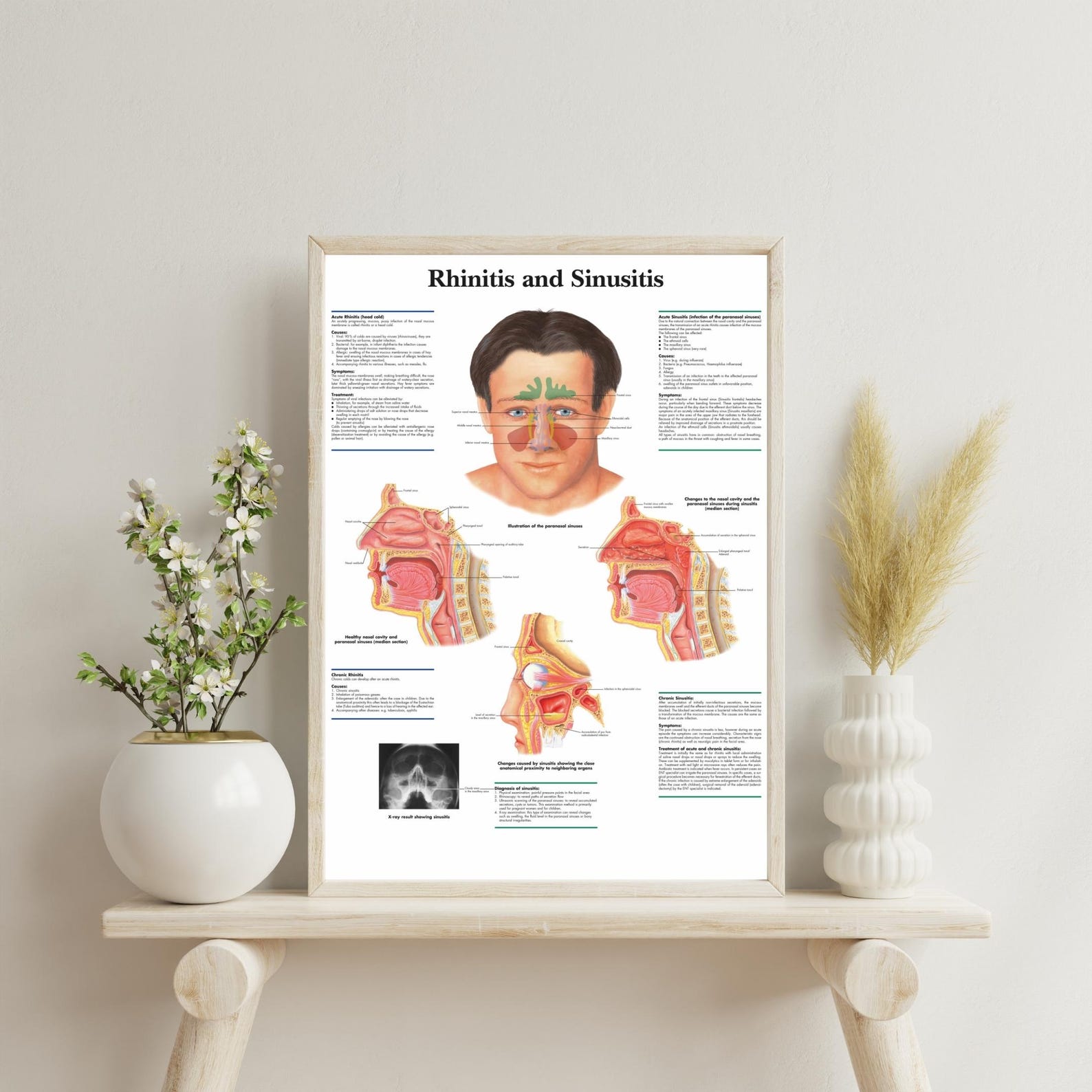 Rhinitis and Sinusitis Chart Anatomy Human Physiology Charts Medical ...