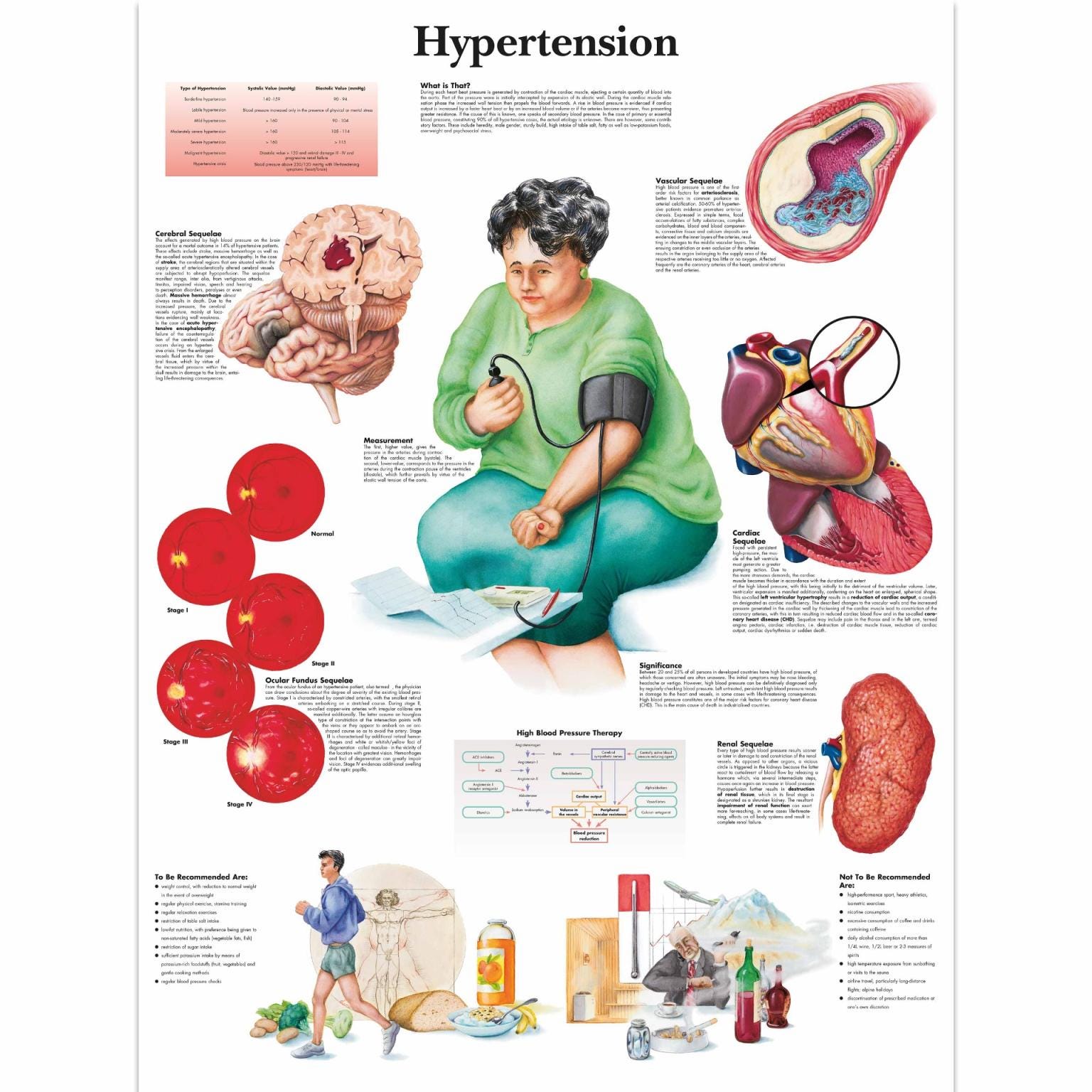 Hypertension Chart Anatomy Human Physiology Charts Medical Student Wall ...