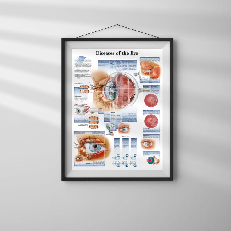 Diseases of the Eye Chart Anatomy Human Physiology Charts Medical ...