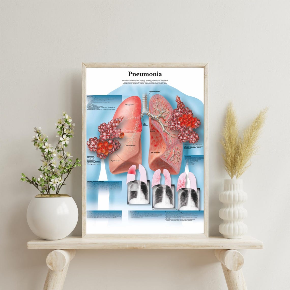 Pneumonia Chart Anatomy Human Physiology Charts Medical Student Wall ...