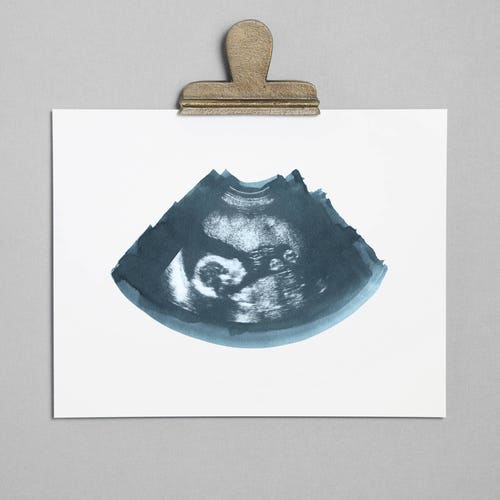 SLATE Ultrasound Sonogram Physical Print - Etsy