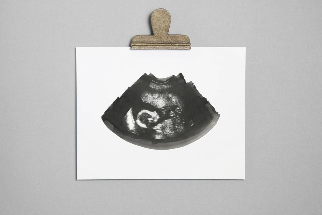 SLATE Ultrasound, Sonogram, Physical Print - Etsy