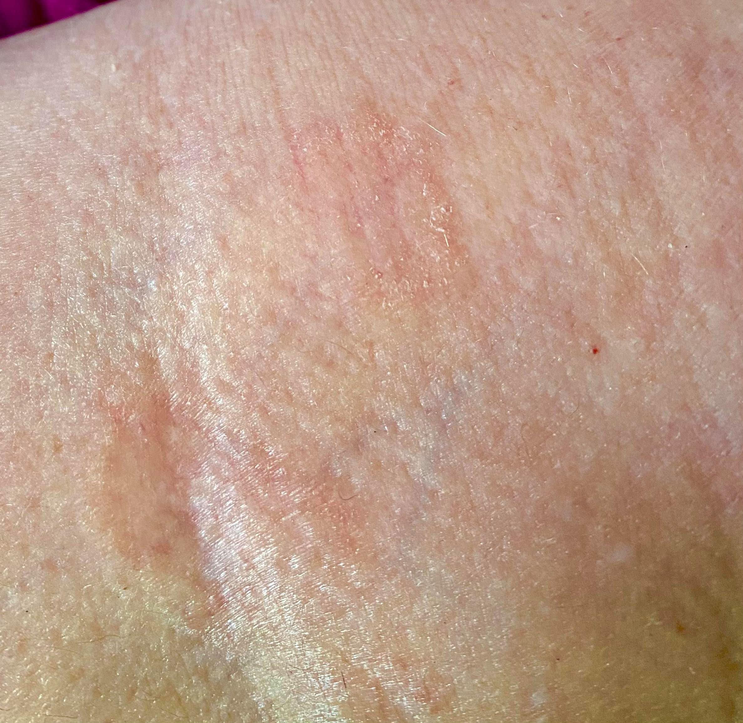 Creams For Pityriasis Rosea at Makayla Conrick blog