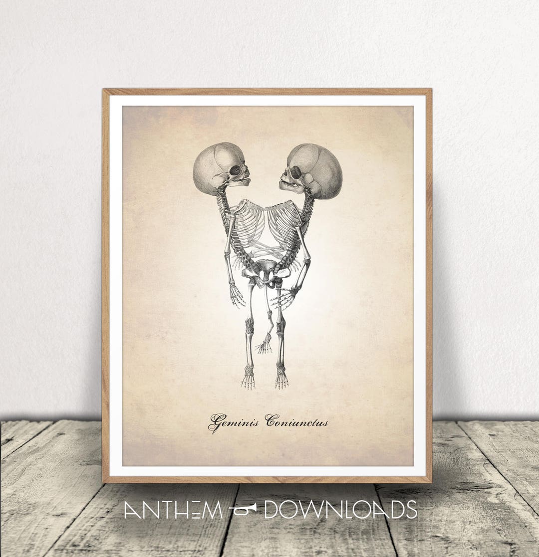 Conjoined Twins Art Print - Anatomy Drawing - Human Anatomy Download ...