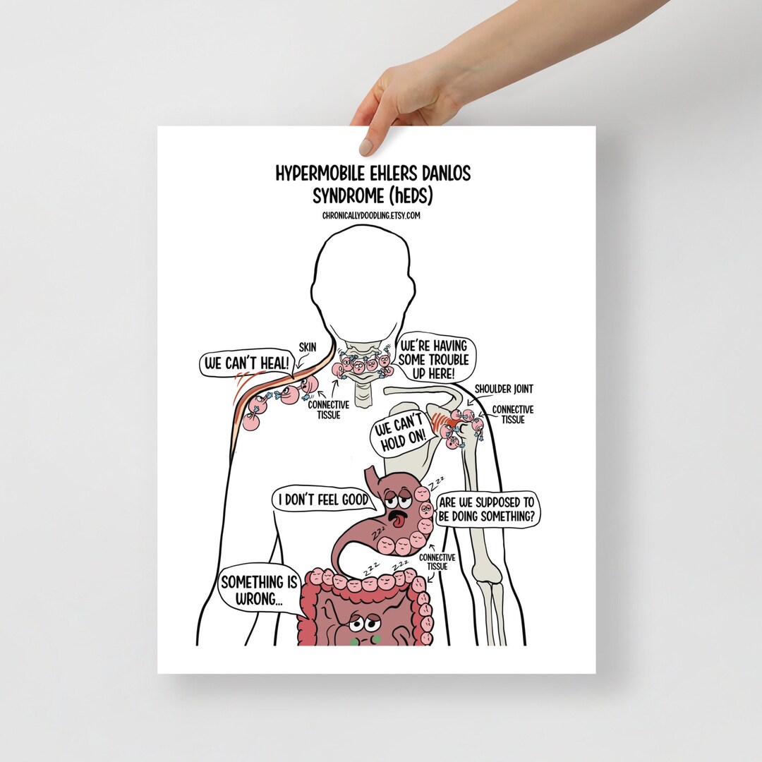 Funny Hypermobile Ehlers Danlos Syndrome (heds) Cartoon Poster - Etsy