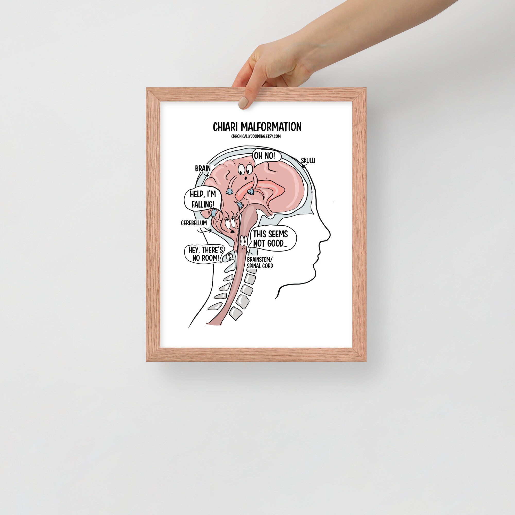 CHIARI MALFORMATION Medical Cartoon Funny Framed Poster - Etsy