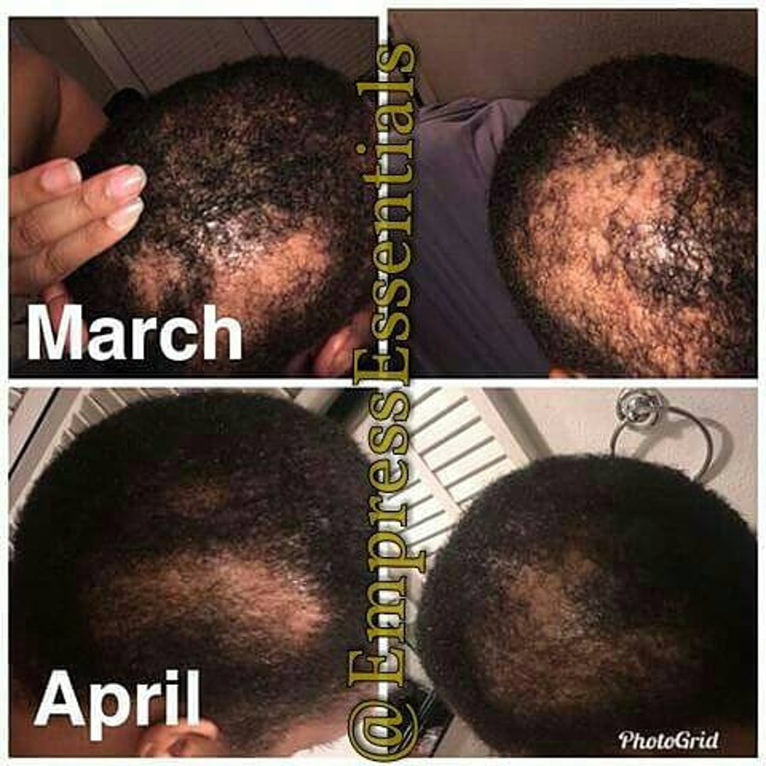Hair Loss Treatment Hair Growth Cream 1 Month Supply Balding Alopecia ...