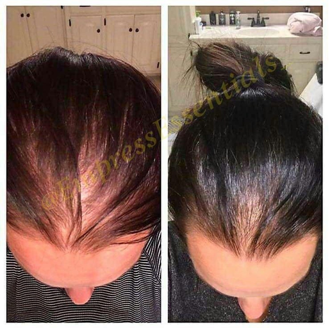 Hair Loss Treatment Hair Growth Cream 1 Month Supply Balding Alopecia ...