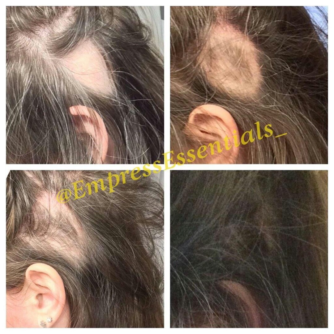 Hair Loss Treatment Hair Growth Cream 2 Month Supply Balding Alopecia ...
