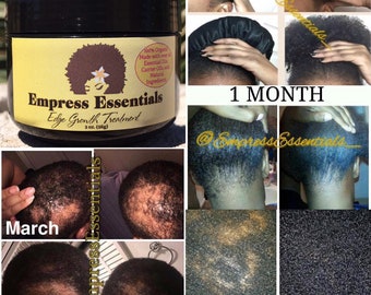 Hair Loss Treatment Hair Growth Cream 2 Month Supply Balding Alopecia ...