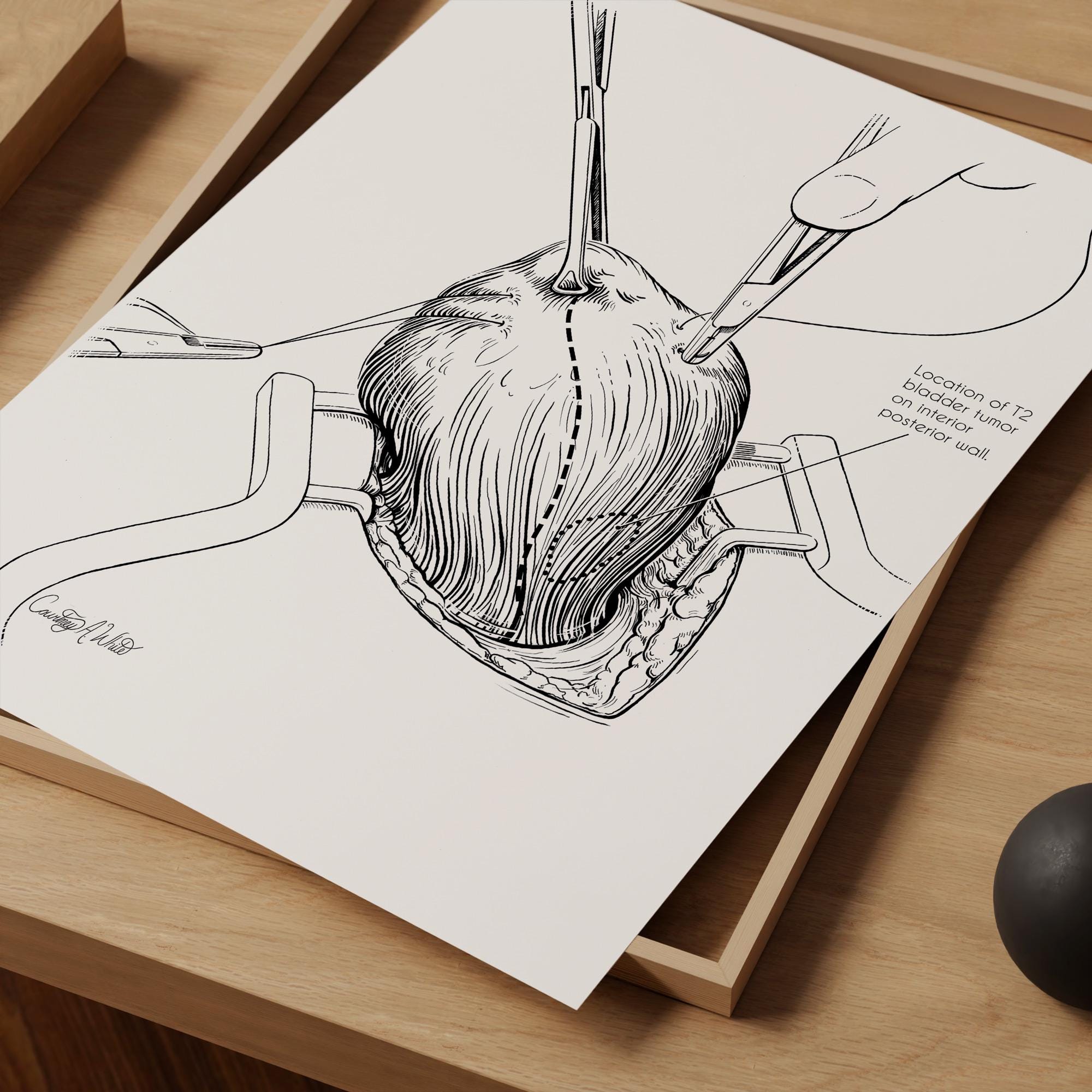 Bladder Surgery Medical Illustration Wall Art Doctor's Office, Medical ...