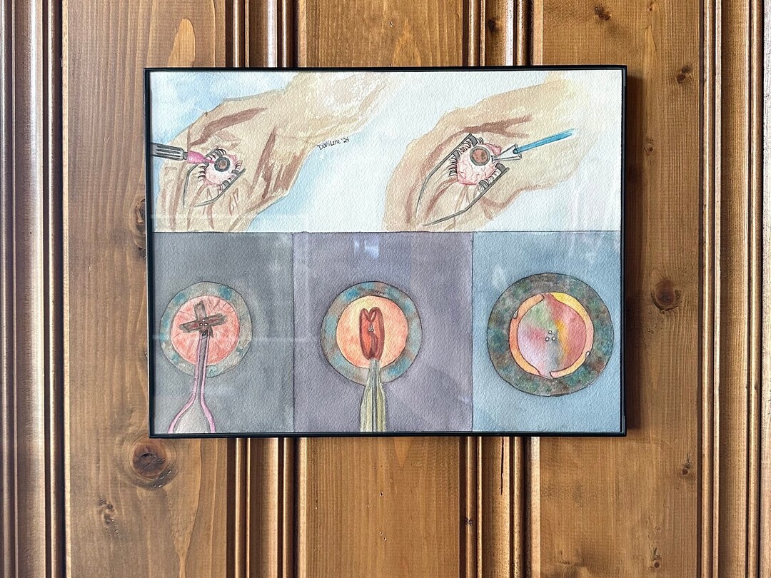 Colors in Cataract Surgery, IOL, Intraoccular Lense Colors, Eye ...