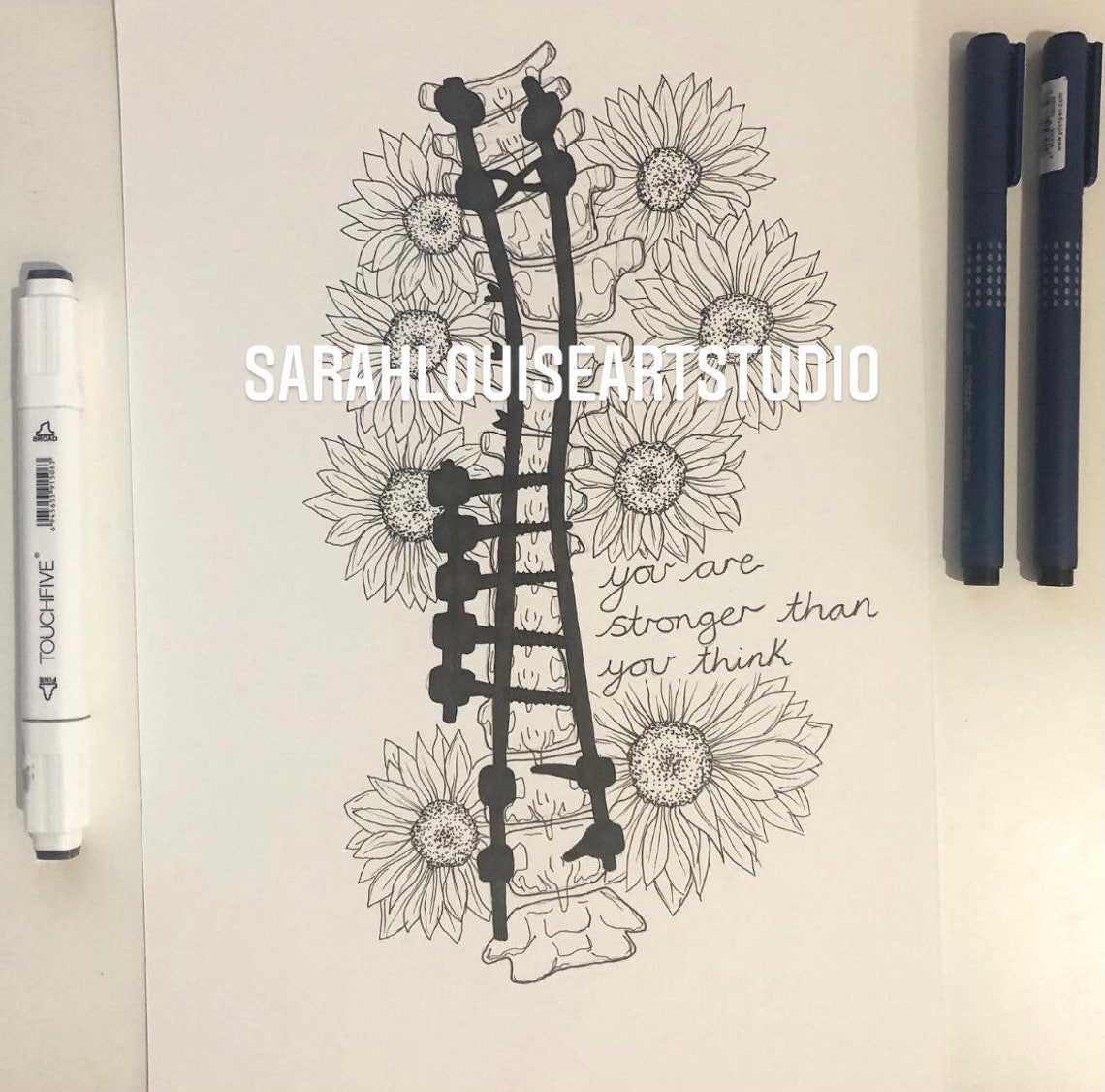 A4 Custom Hand Drawing Spinal Fusion / Scoliosis (one Line Drawing ...