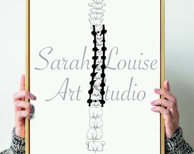 Custom Scoliosis / Spinal Fusion Digital Art Print PRINTABLE File ...