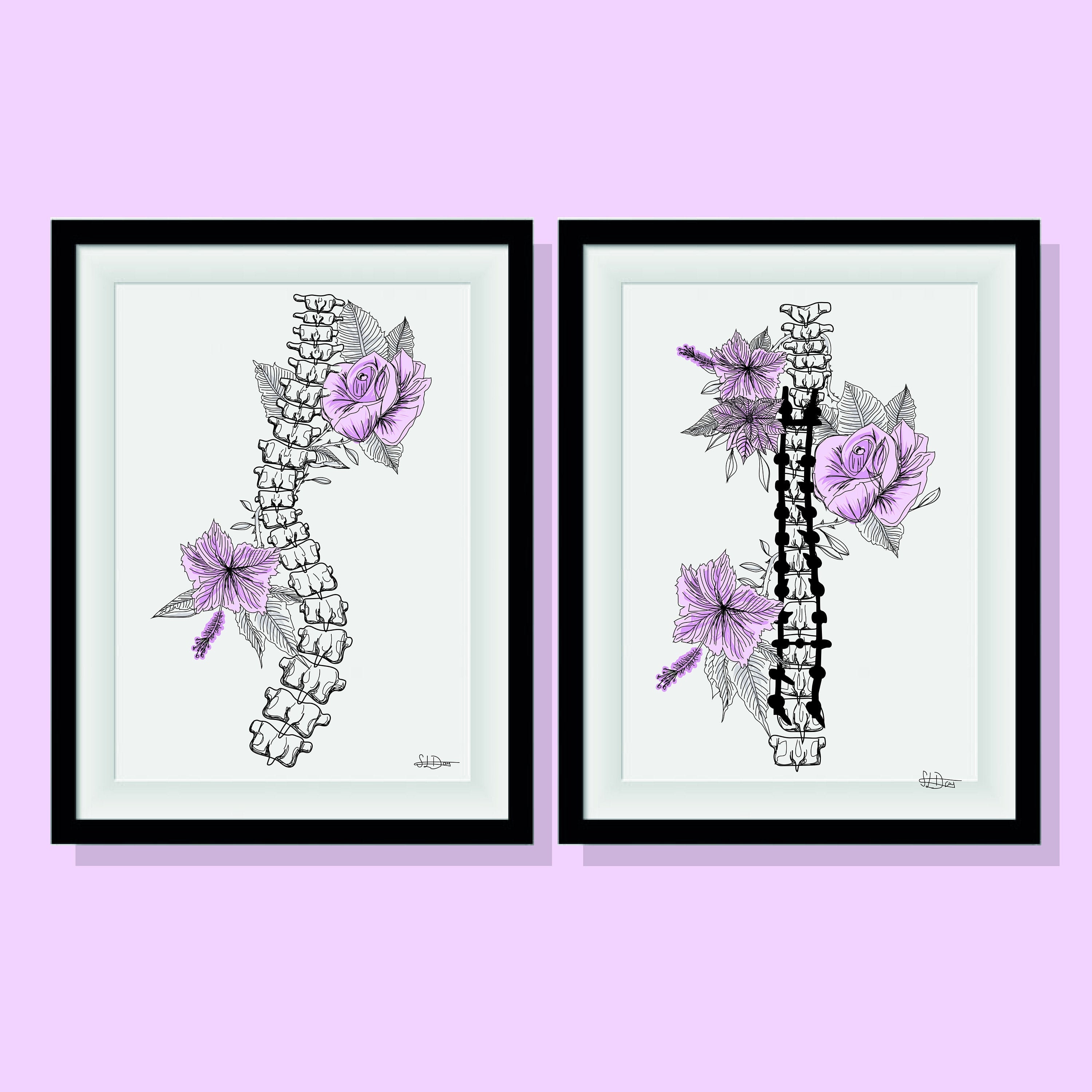 Scoliosis Spine Drawing