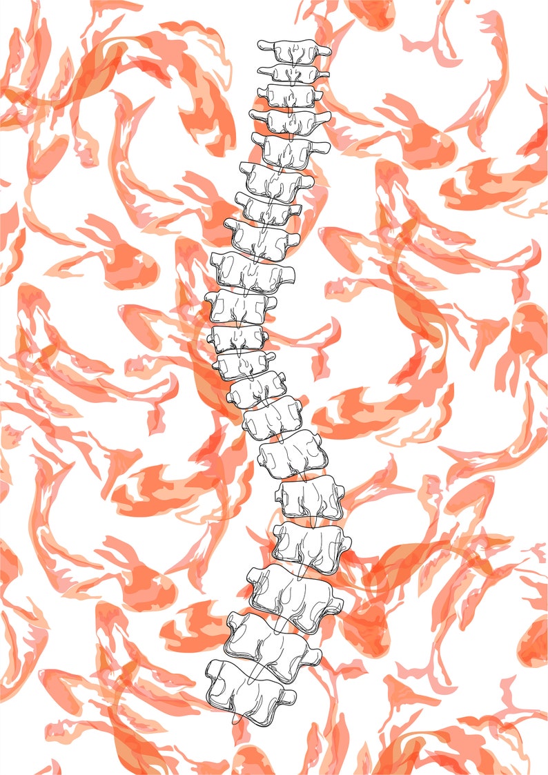 Custom Scoliosis / Spinal Fusion Digital Art Print PRINTABLE File ...