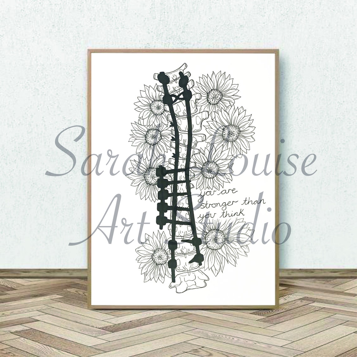 A4 Custom Hand Drawing Spinal Fusion / Scoliosis (one Line Drawing ...