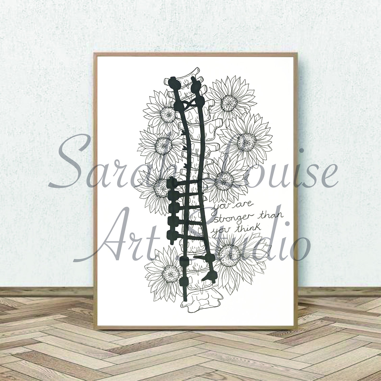 A4 Custom Hand Drawing Spinal Fusion / Scoliosis (one Line Drawing ...