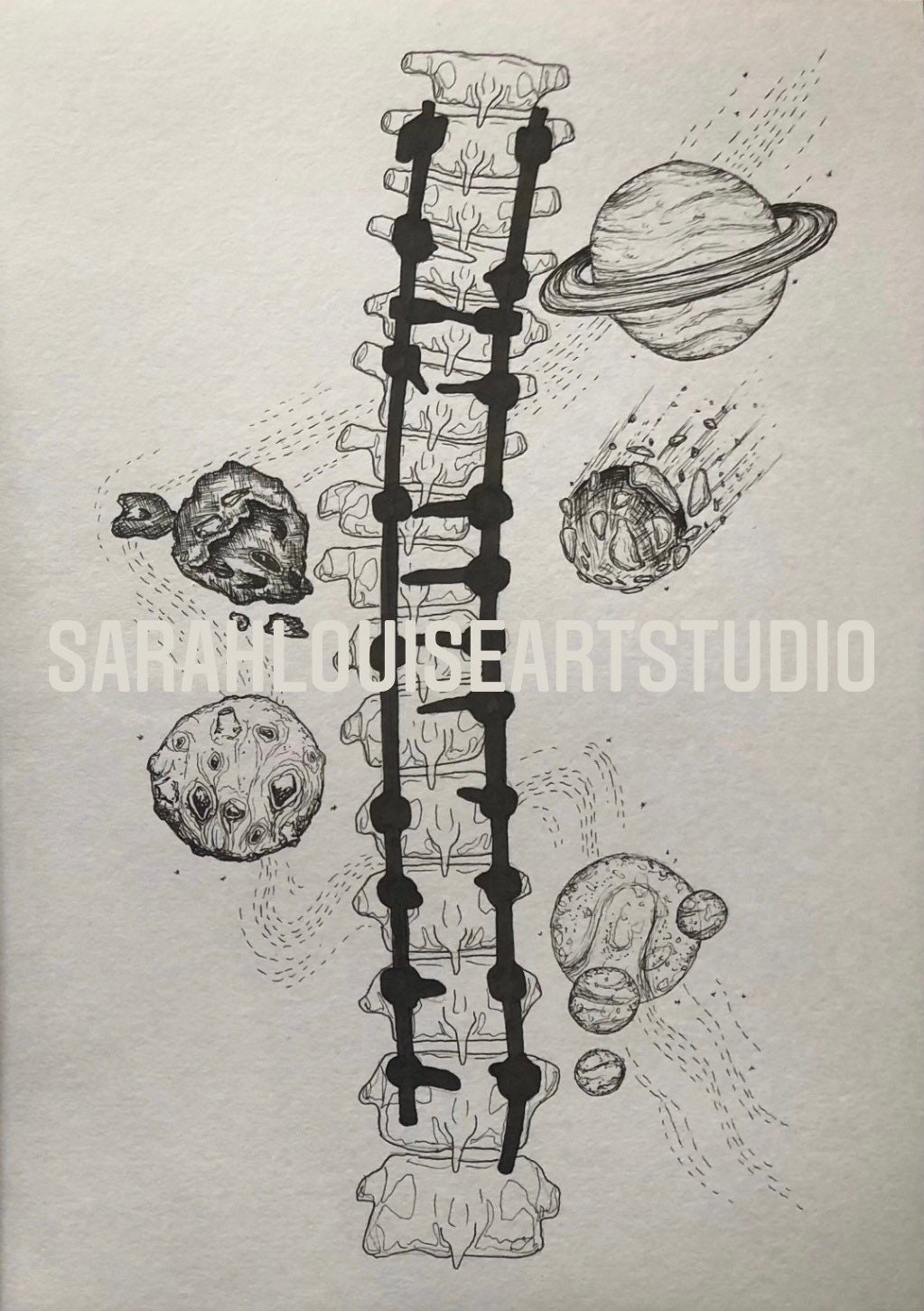 A4 Custom Hand Drawing Spinal Fusion / Scoliosis (one Line Drawing ...