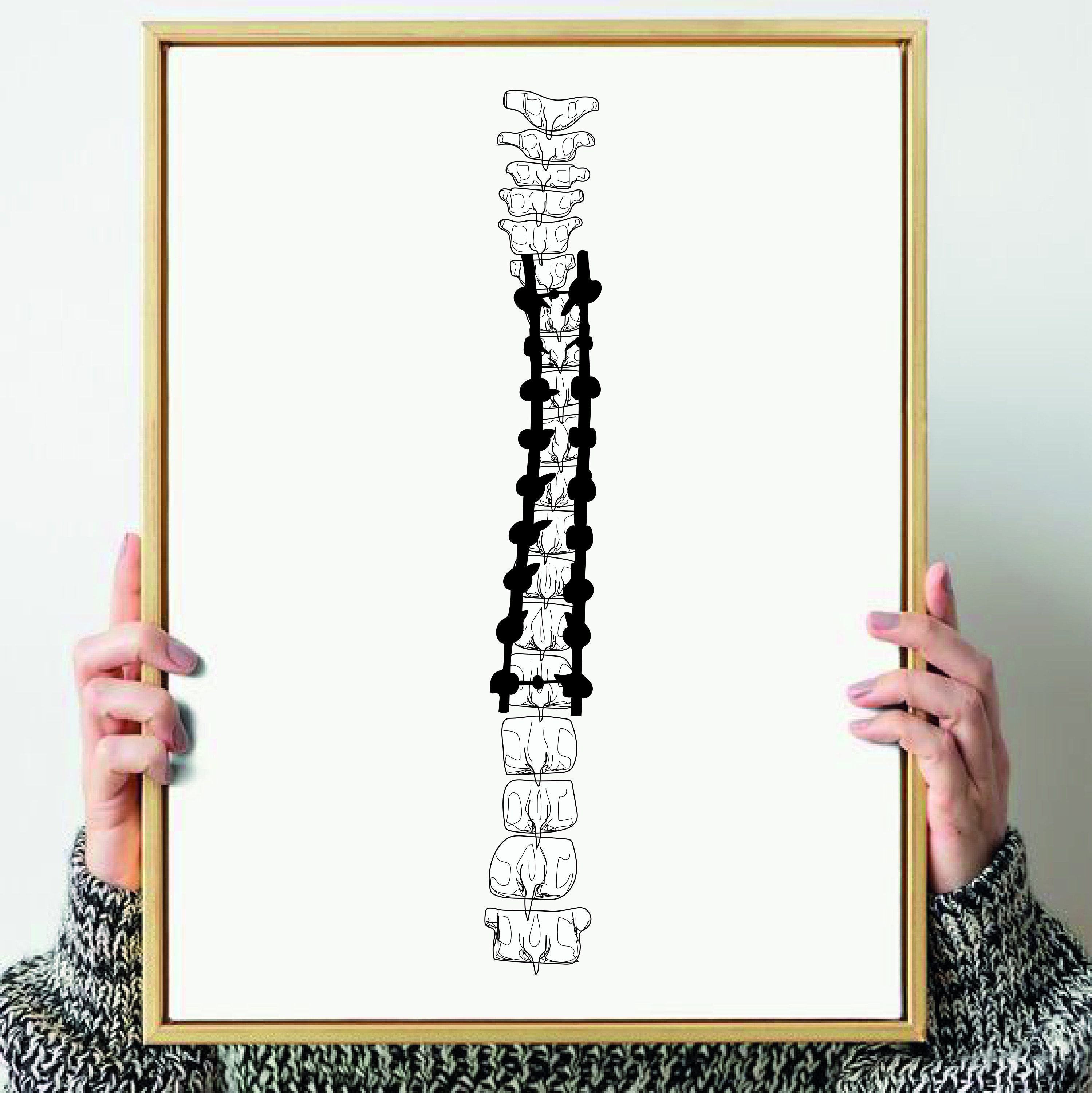 Custom Scoliosis / Spinal Fusion Digital Art Print PRINTABLE | Etsy