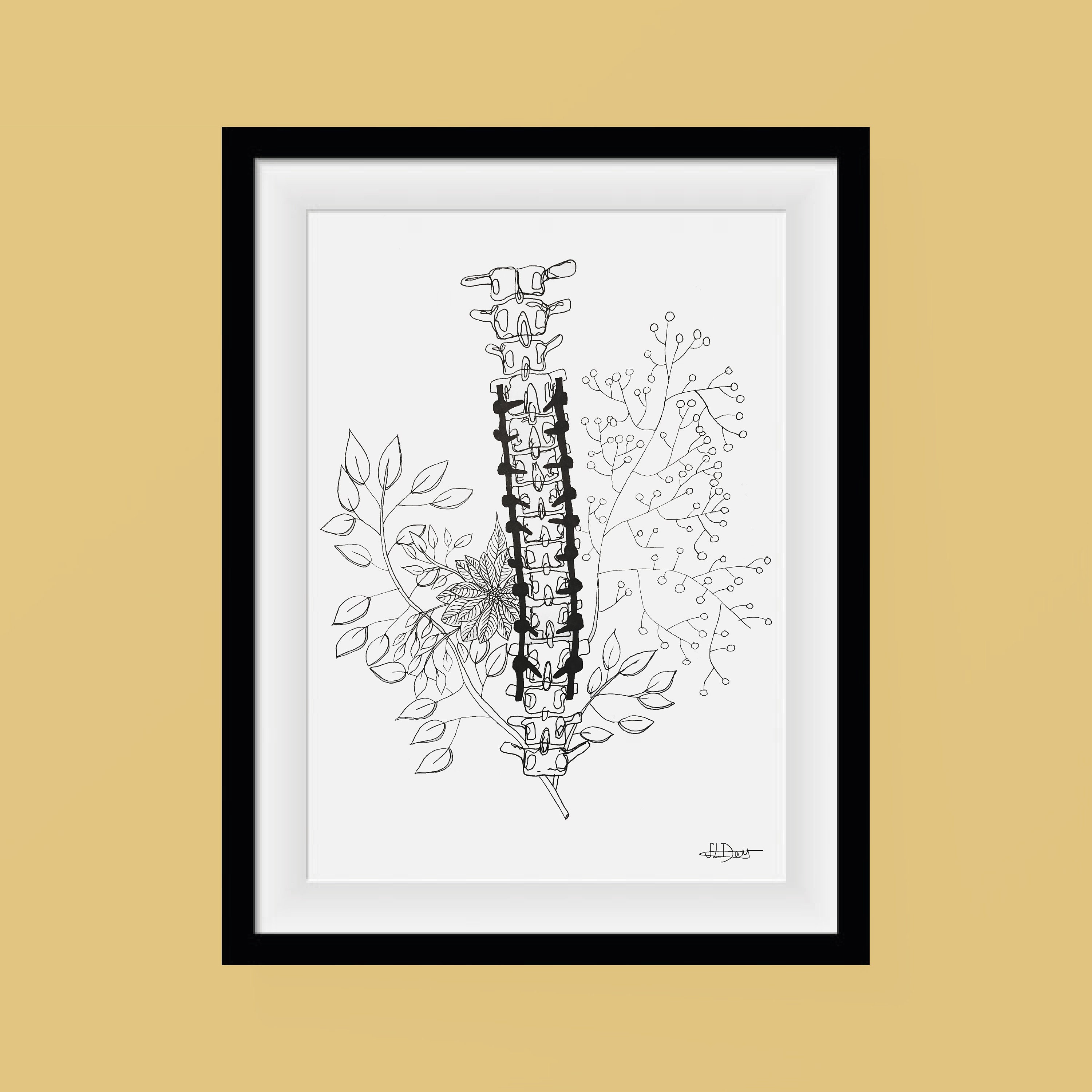 A4 Custom Hand Drawing Spinal Fusion / Scoliosis (one Line Drawing ...