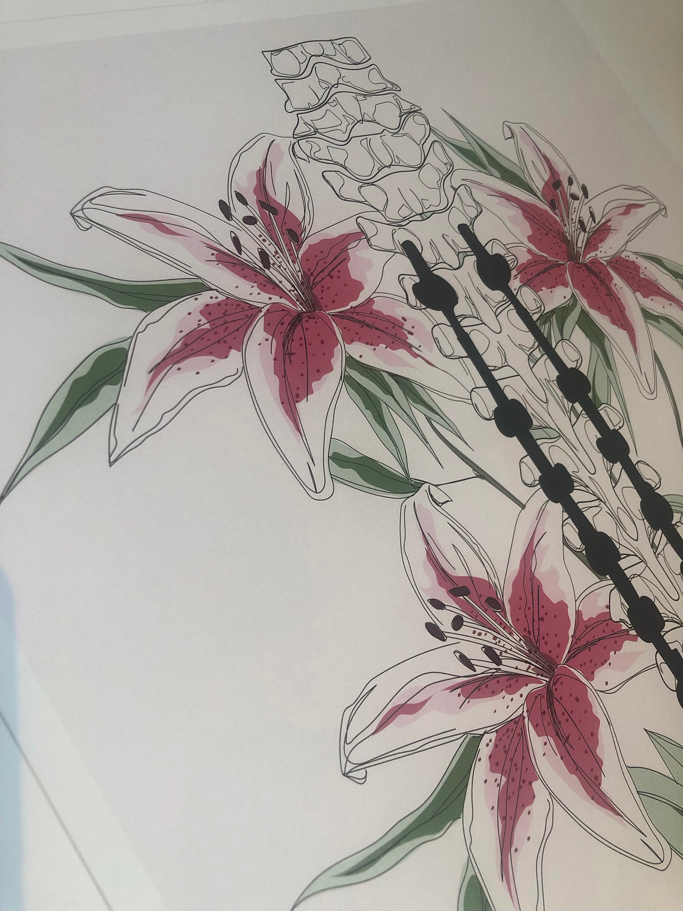A4 Spinal Fusion Print With Lilies scoliosis Kyphosis - Etsy