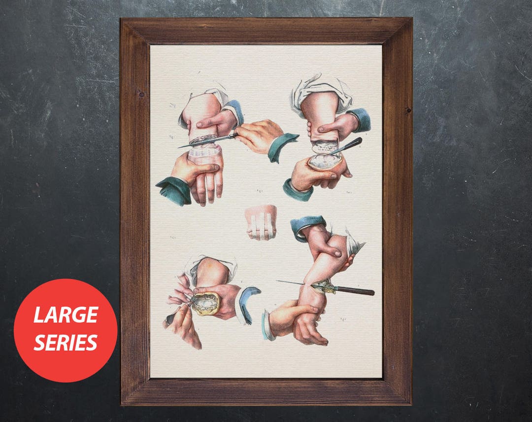Anatomy Art HAND AMPUTATION Amputate Medical Student Gift, Anatomical ...