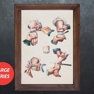 Anatomy Art HAND AMPUTATION Amputate Medical Student Gift, Anatomical ...