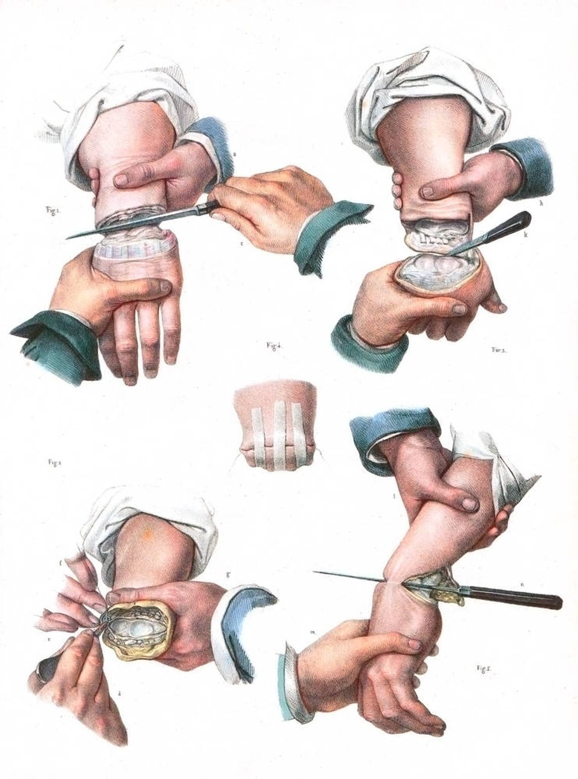 Anatomy Art HAND AMPUTATION Amputate Medical Student Gift, Anatomical ...