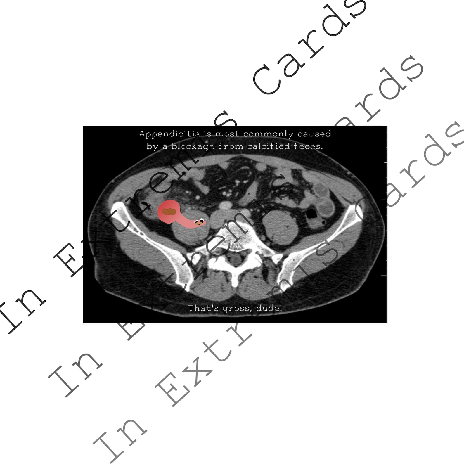 Funny Appendectomy Get Well Card (appendix Surgery Removal ...