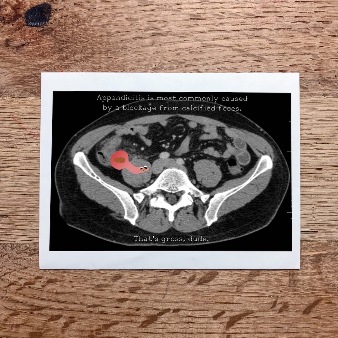 Funny Appendectomy Get Well Card (appendix Surgery Removal ...
