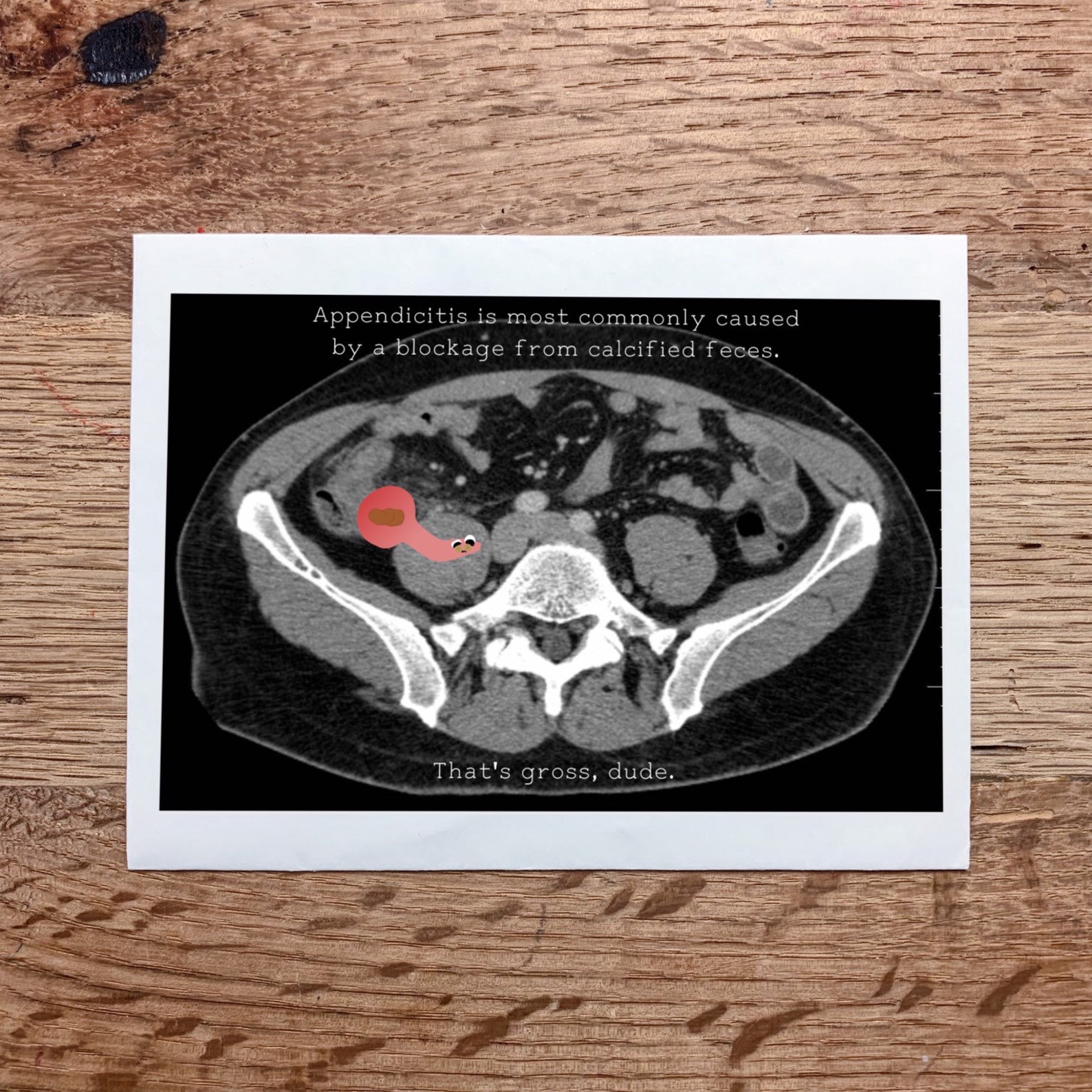 Funny Appendectomy Get Well Card (appendix Surgery Removal ...