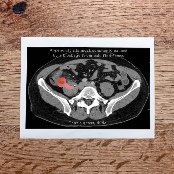 Funny Appendix Card - Etsy