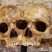 Conjoined Twins Human Skull **FREE SHIPPING* - Etsy