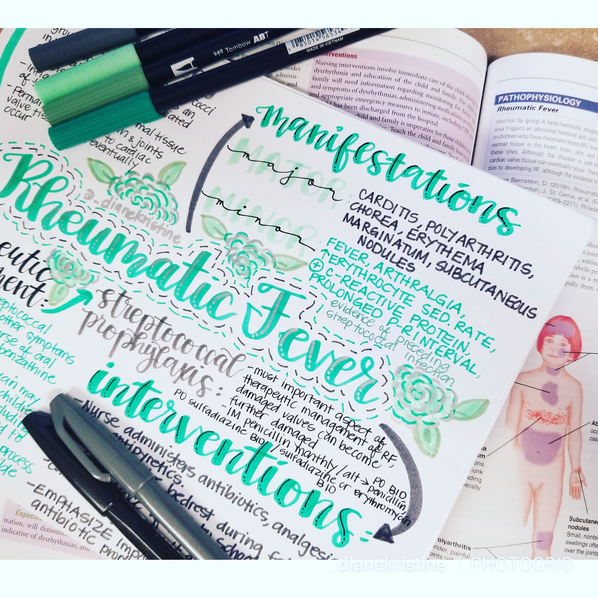 Rheumatic Fever- Nursing Notes/ Concept Map- Pediatrics Semester - Etsy