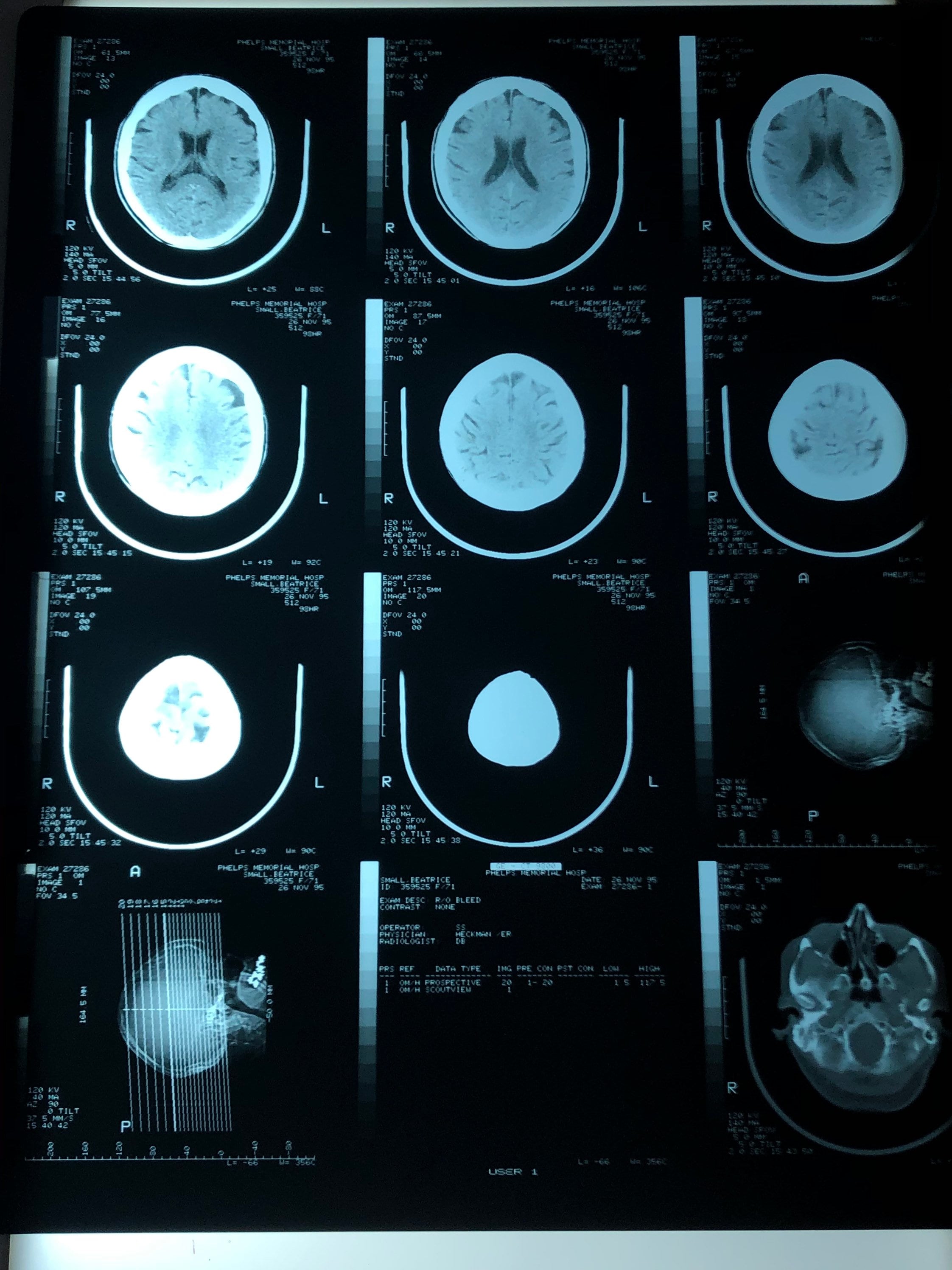 Authentic CAT CT Scan X-Ray Film 14x17 Skull Brain Head | Etsy